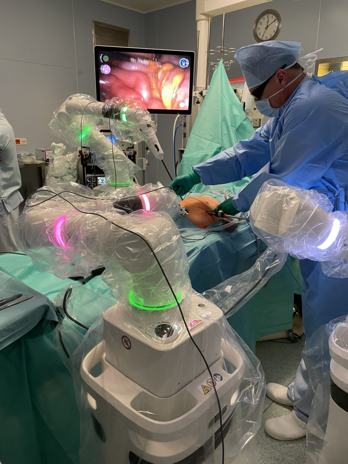 Versius robotic system - Promedica